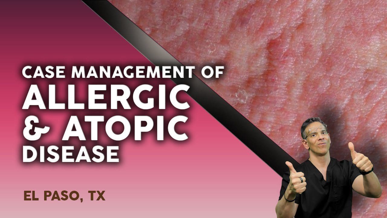 Allergic & Atopic Disease | El Paso, Tx (2021) - Integrative Wellness ...