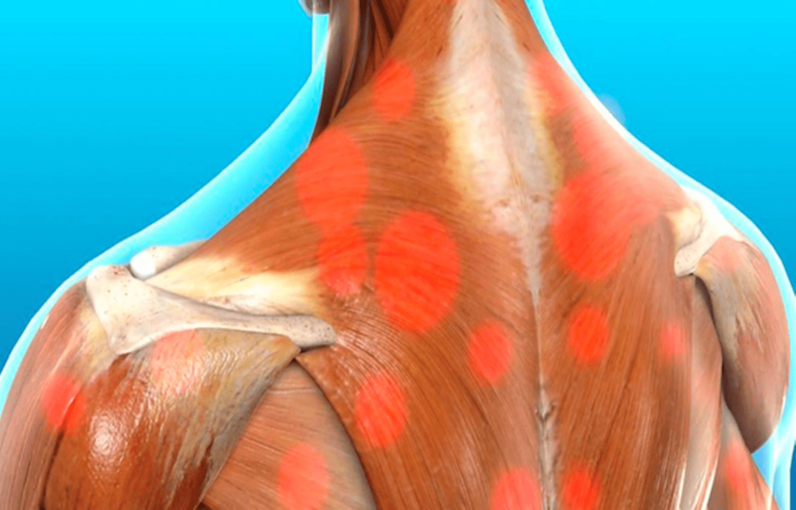 Trapezius Muscle Syndrome Pain In Trapezius | Trap Muscle | Florida